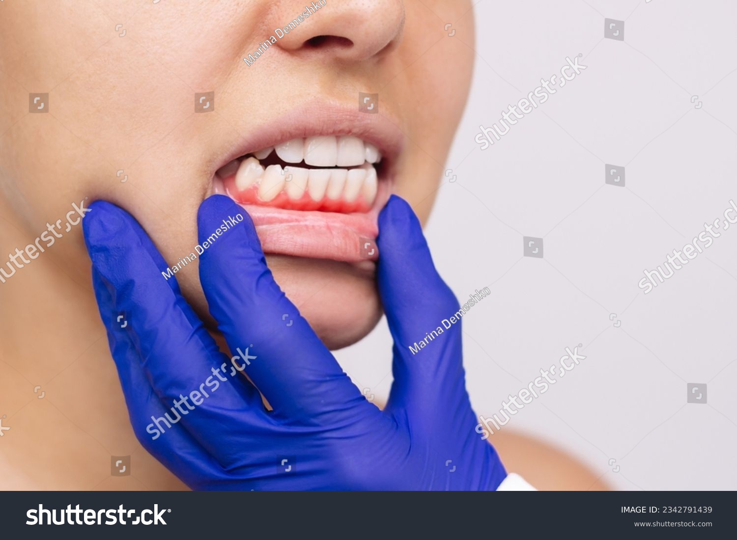 Soft Tissue Treatments - Horasan Dental